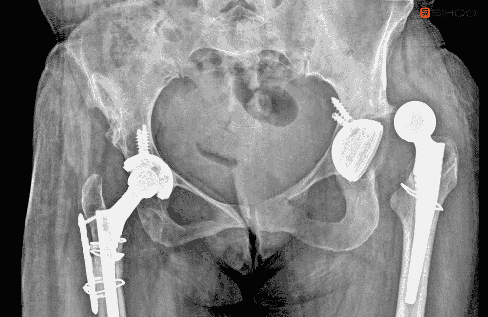 Feeling Lopsided? 7 Key Signs Your Hip Is Out of Alignment – UK Sihoo ...